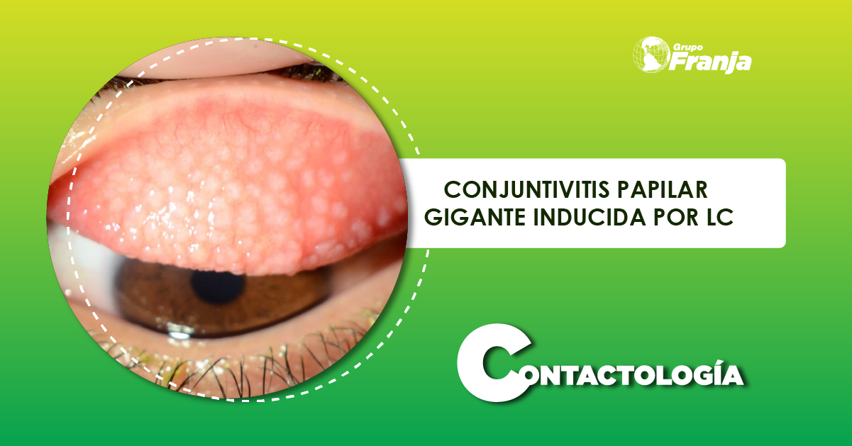 CONJUNTIVITIS PAPILAR GIGANTE INDUCIDA POR LC | Grupo franja