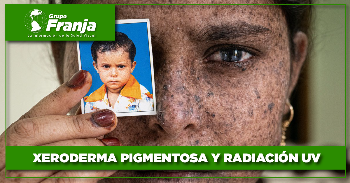 Xeroderma pigmentosa y radiación UV - Grupo franja