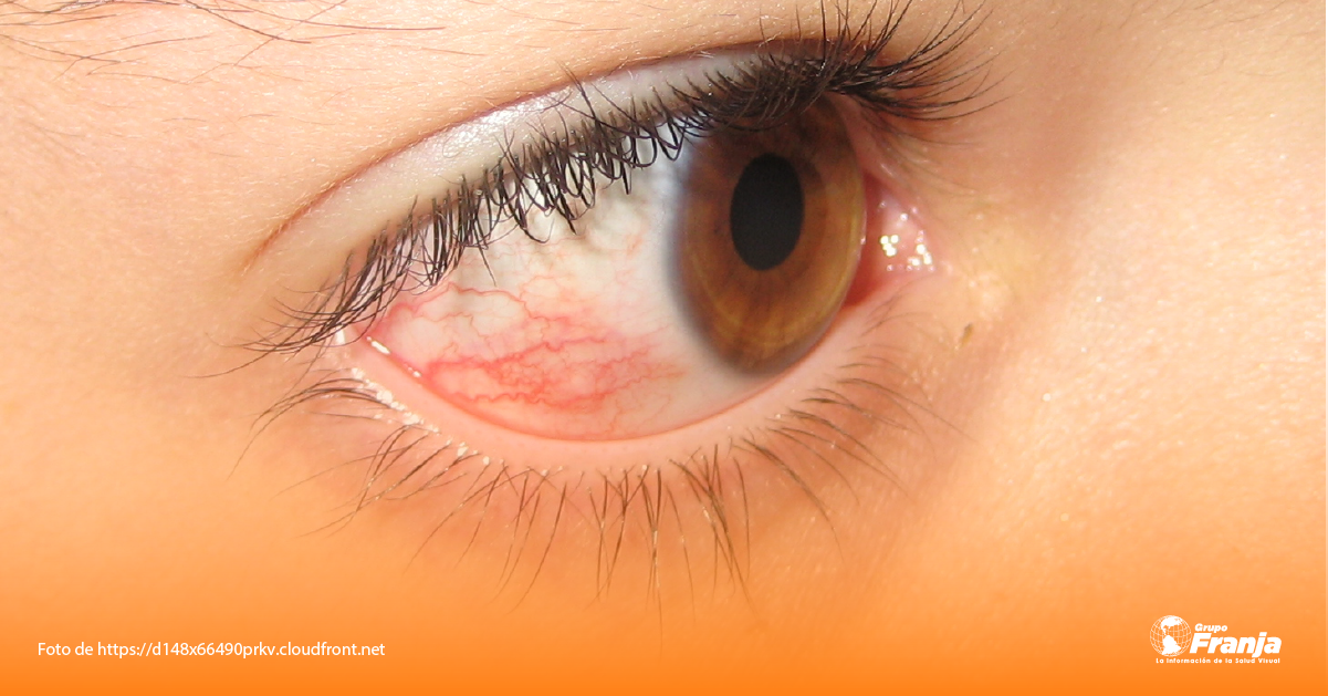 Un abordaje de la epiescleritis | Grupo franja