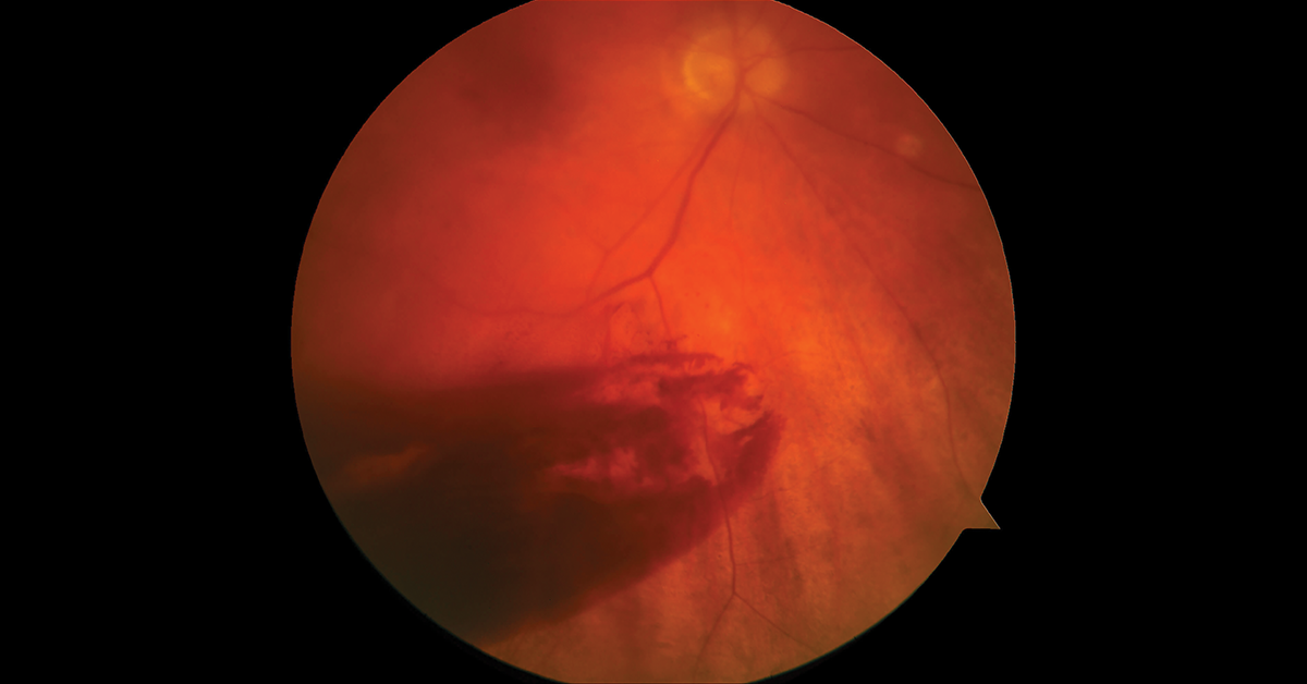 Un vistazo a la hemorragia vítrea patogénesis - Grupo franja